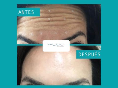 Botox Medellín - María Isabel Arredondo